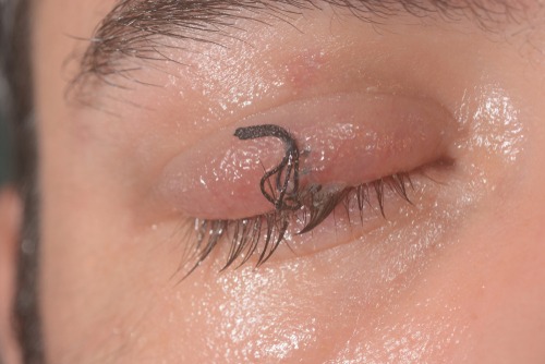 Symblepharon Veterans Benefits | Disabled Vets